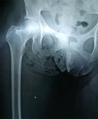 Bone Density Training Prevents Fracture Risk » Mobility360.fit